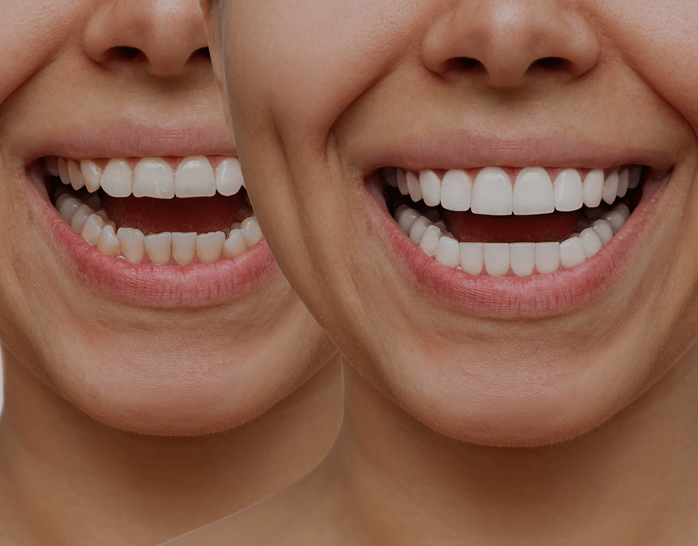 Porcelain Vs. Composite Veneers: Which Is Best? – NatruSmile