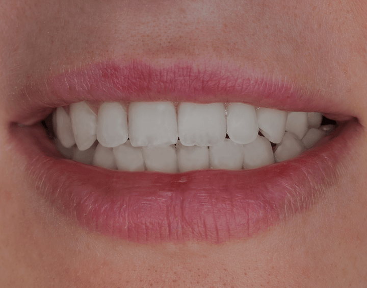 Translucent Teeth: Learn The Causes And Fixes – NatruSmile