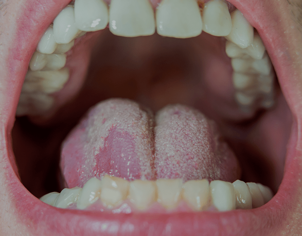 8 Most Common Oral Infections And Treatment Options – NatruSmile