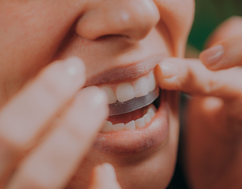 Whitening Pens Vs. Strips: Which Works Better For You? – NatruSmile