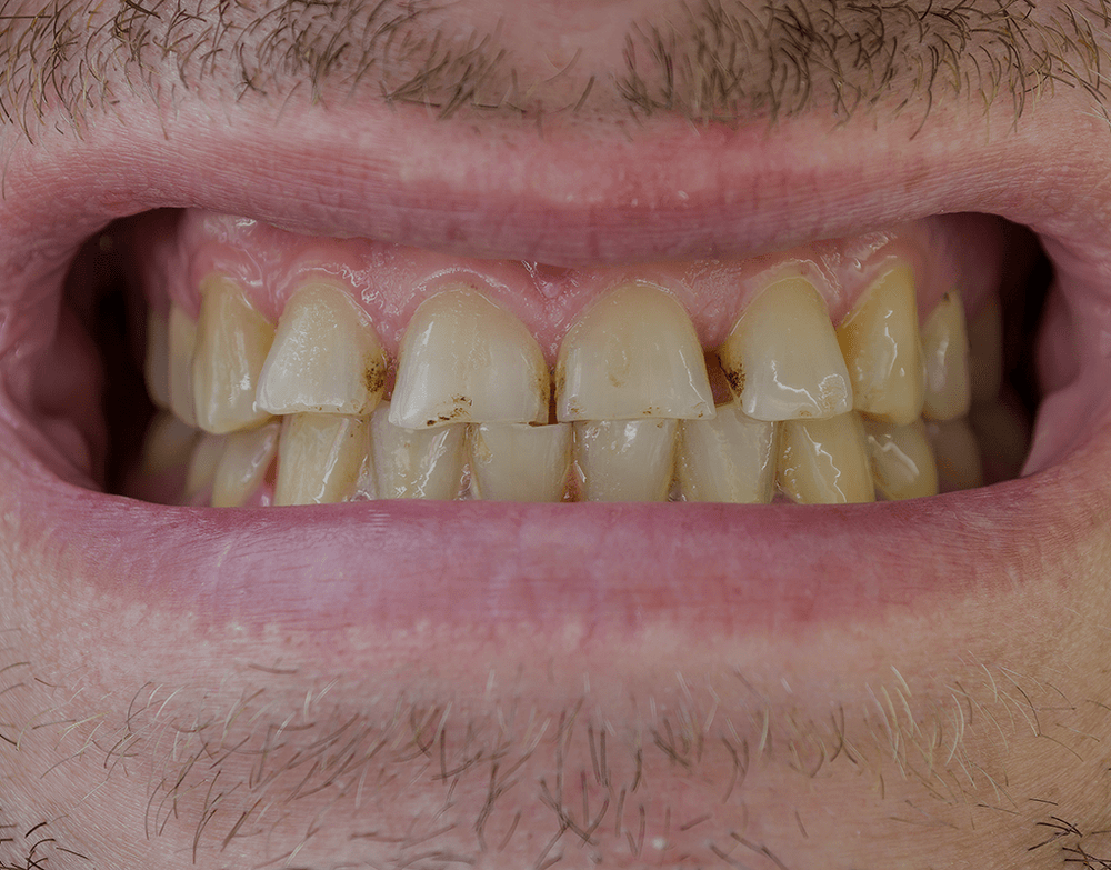 Tooth Discoloration And Stains: Causes And Prevention – NatruSmile