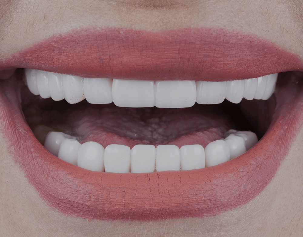 Veneers Vs Crowns: Best Comparison For 2023 – NatruSmile