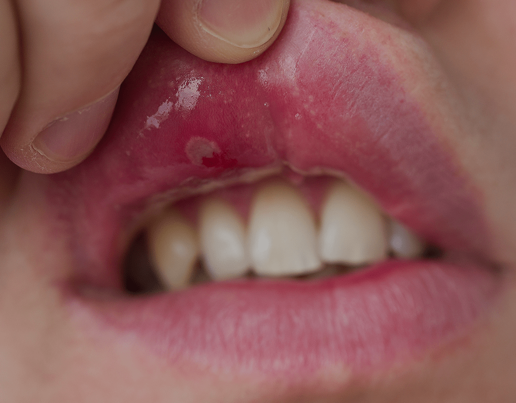 Mouth Ulcers: Causes, Treatment & Prevention – NatruSmile