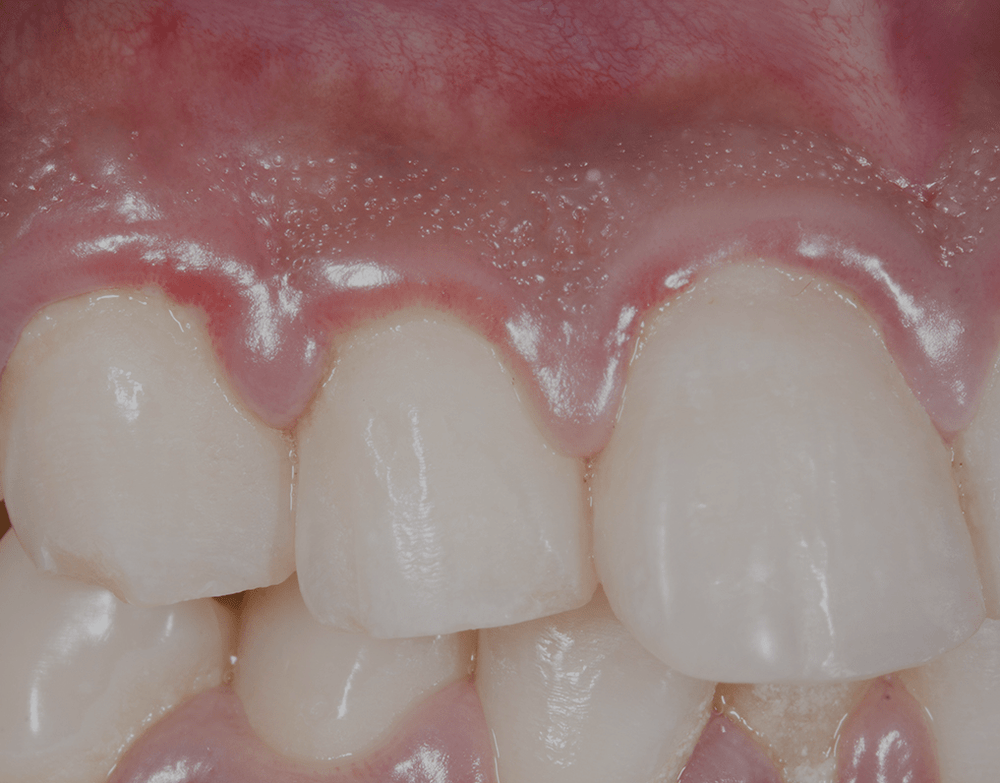 Swollen Gums: Causes, Treatments, And Prevention – NatruSmile