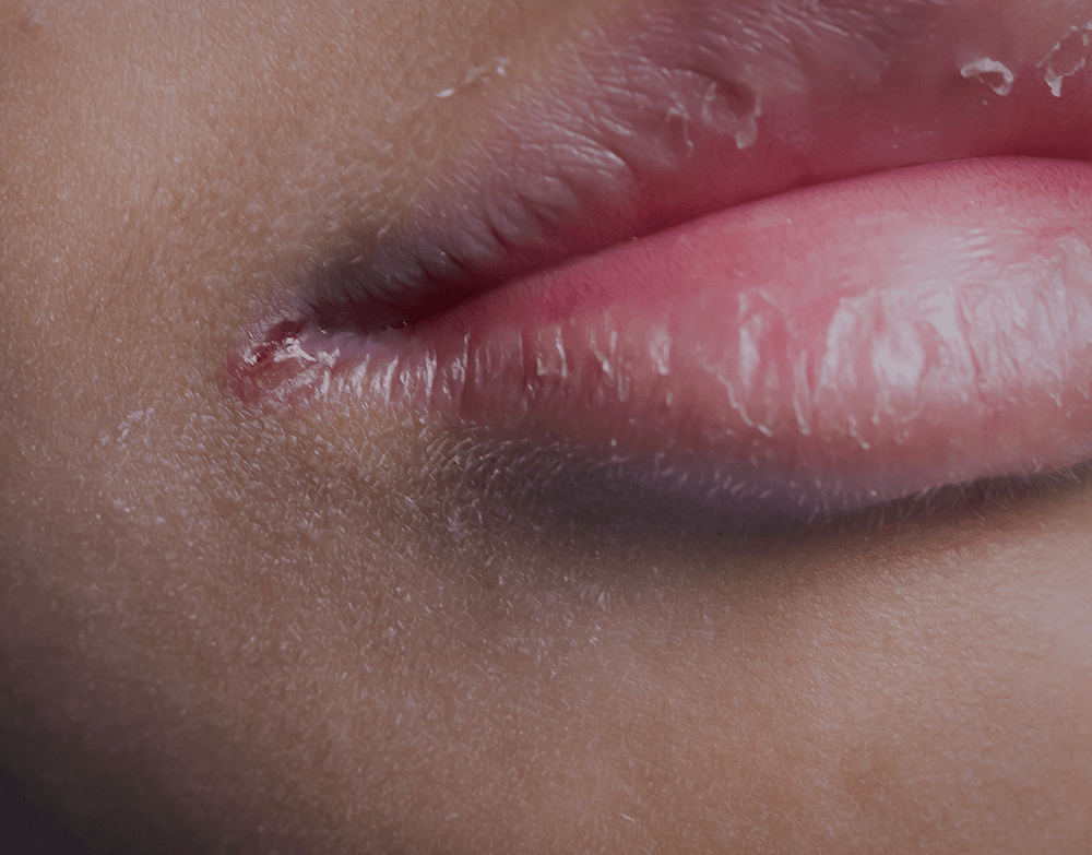 Angular Cheilitis Causes Symptoms Treatment And More Natrusmile