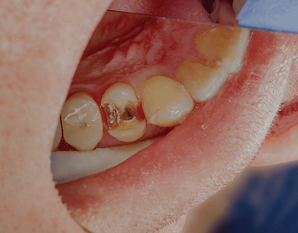 Tooth Decay Treatment Methods And Prevention Tips – NatruSmile