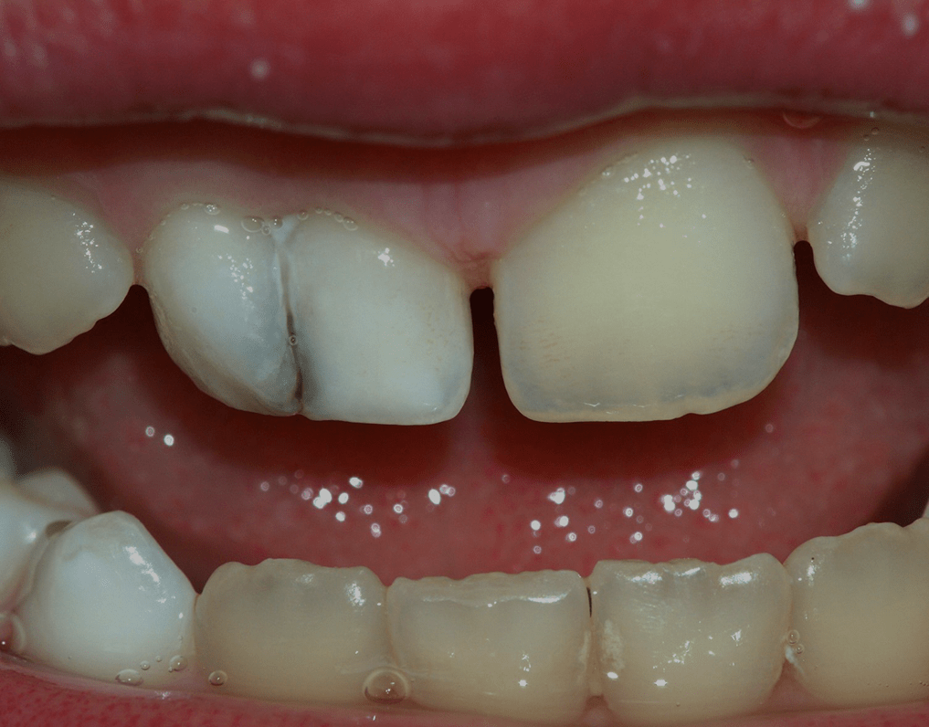 Tooth Gemination Causes And Treatments – NatruSmile
