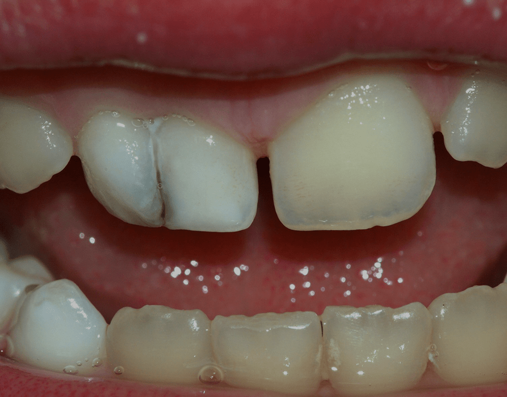 Tooth Gemination Causes And Treatments – NatruSmile