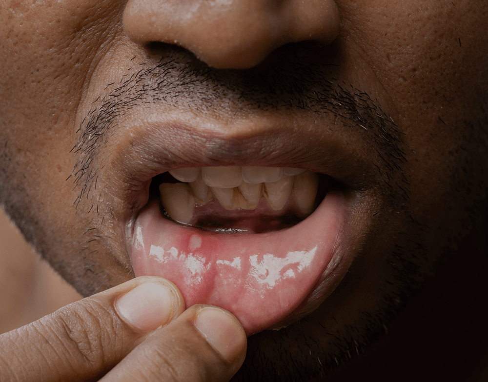White Spots On Gums: Causes, Treatment And Prevention – NatruSmile