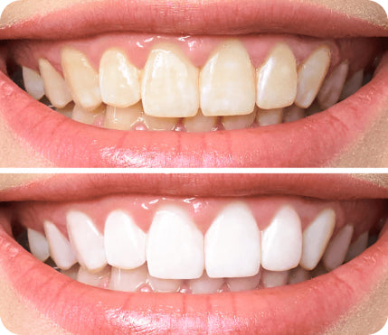 Top 5 Essential Vitamins For Healthy Teeth And Gums – NatruSmile